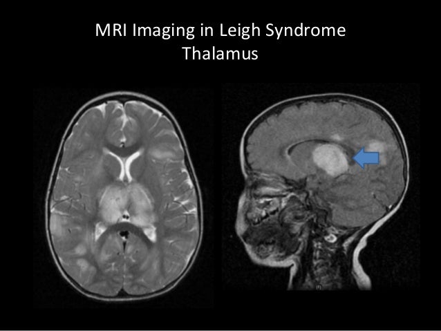 Leigh Syndrome - Mary Kay Koenig, MD