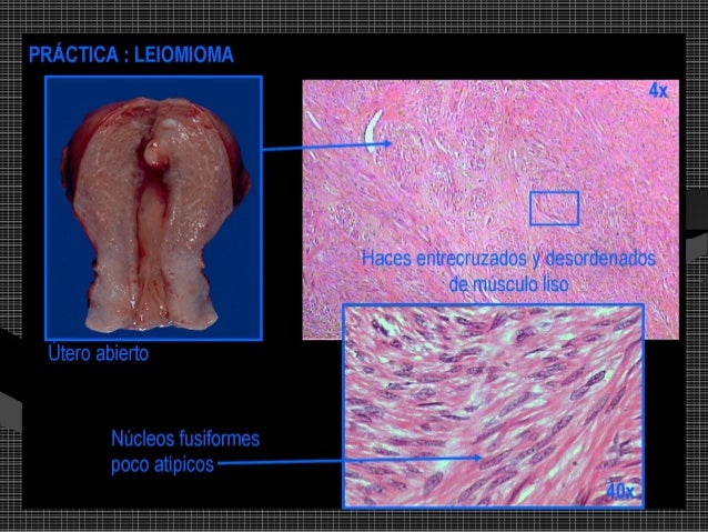 Leiomioma utero