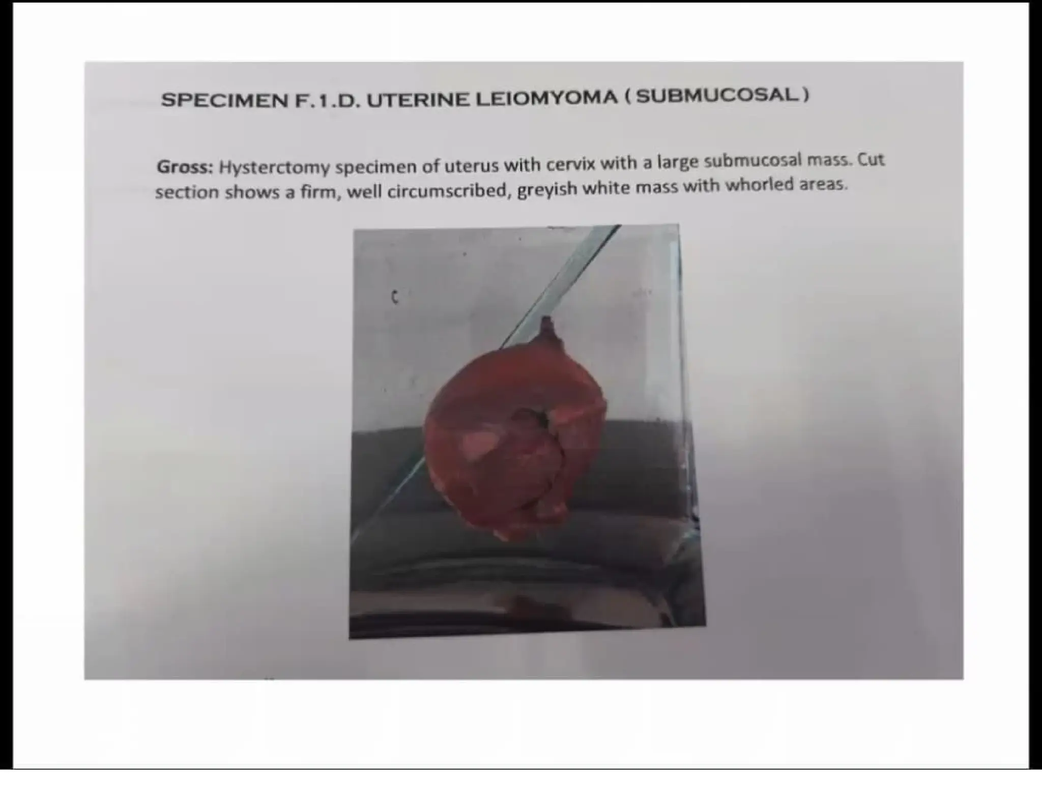Leiomyoma of uterus,patho practical (1).p | PPTX