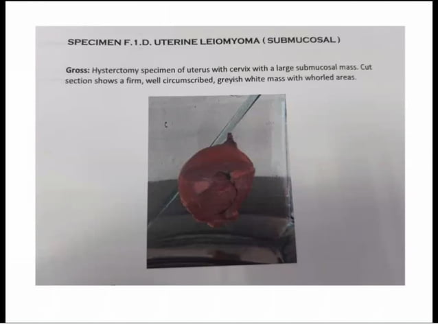 Leiomyoma of uterus,patho practical (1).p | PPTX