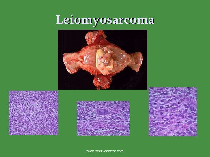 Leiomyomas