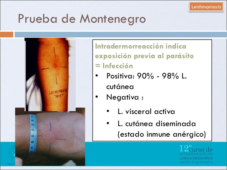 Leishmania