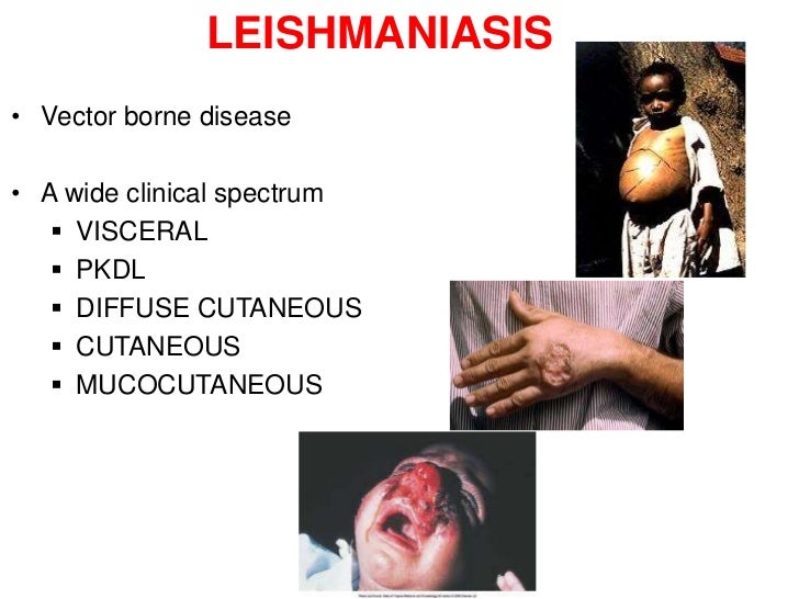Leishmaniasis