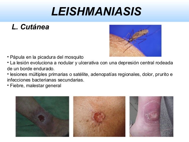 Leishmaniasis