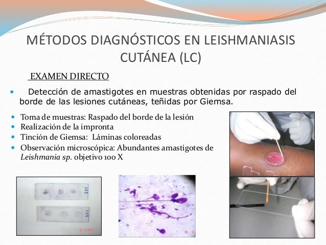 Leishmaniasis