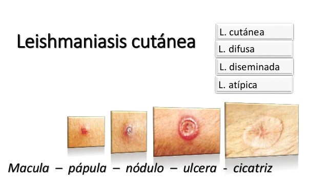 Leishmaniasis