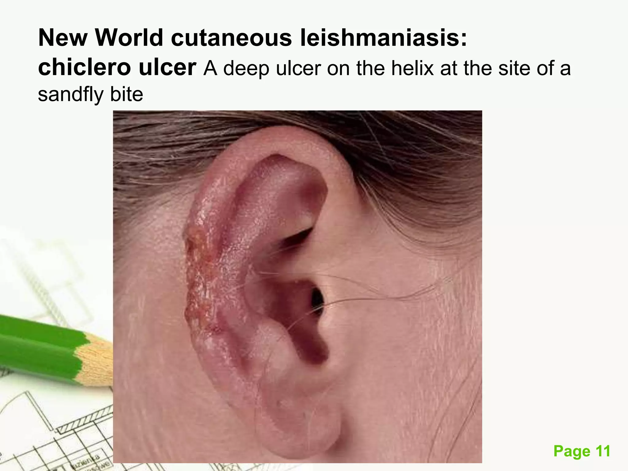 Leishmaniasis | PPT