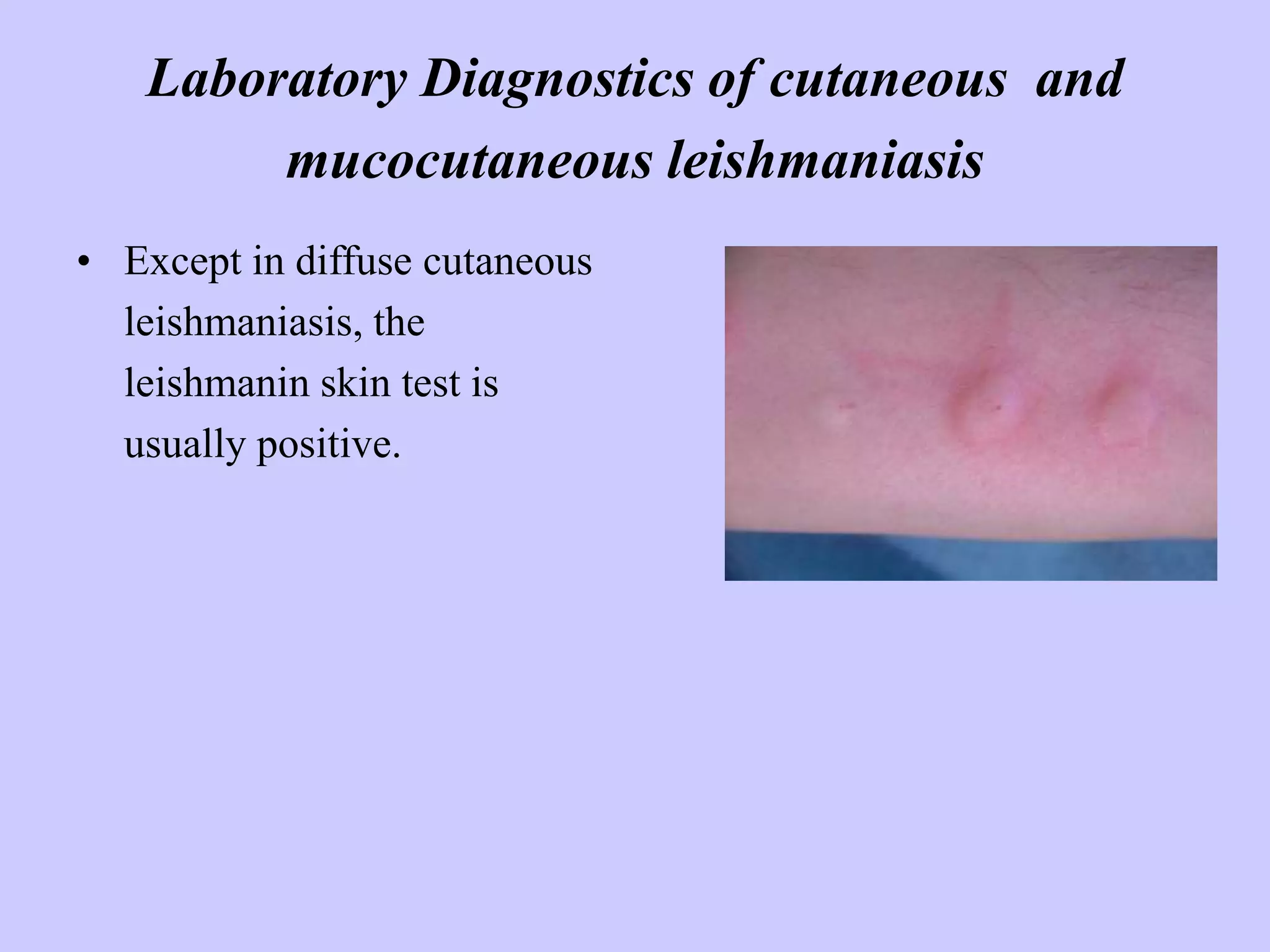 Leishmaniasis.ppt