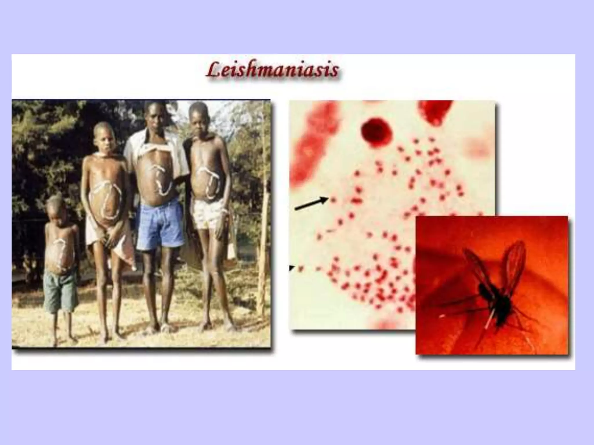 Leishmaniasis (2).ppt