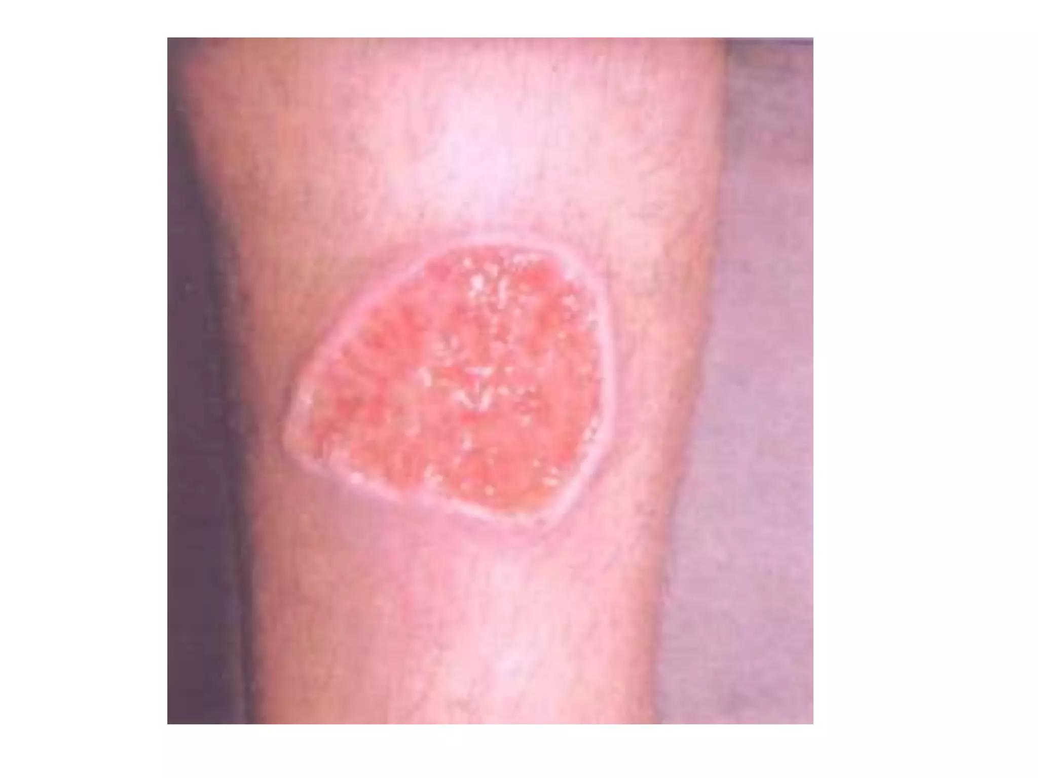 Leishmaniasis cutánea | PPT