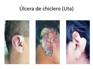 Leishmaniasis cutánea | PPTX