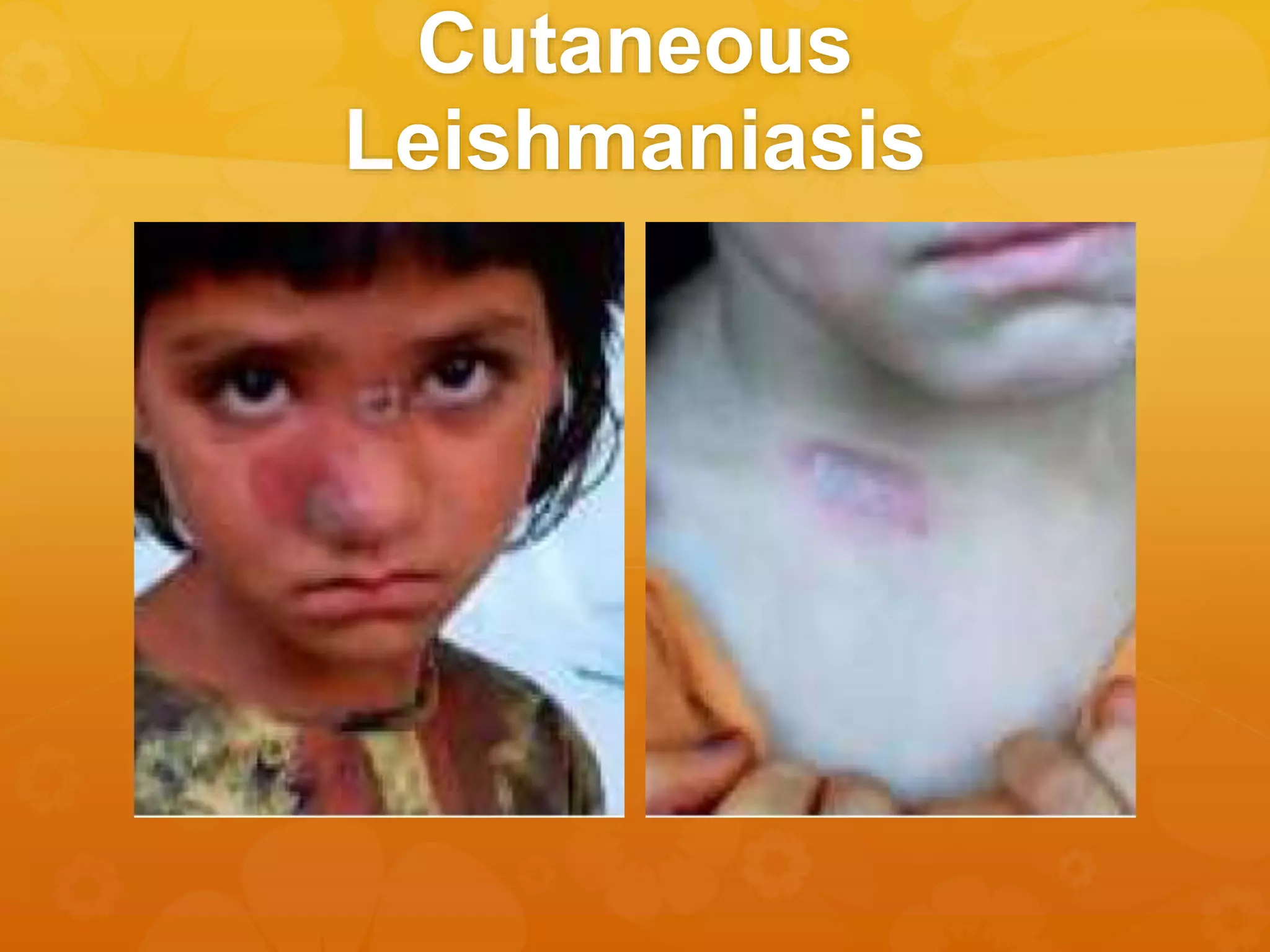 Leishmaniasis in pakistan | PPTX