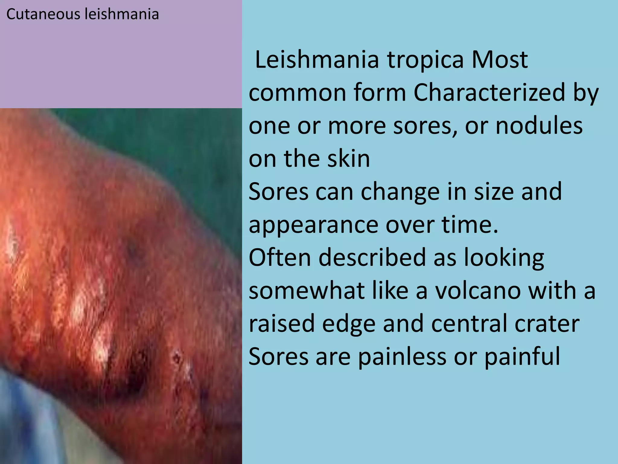 Leishmaniasis | PPTX