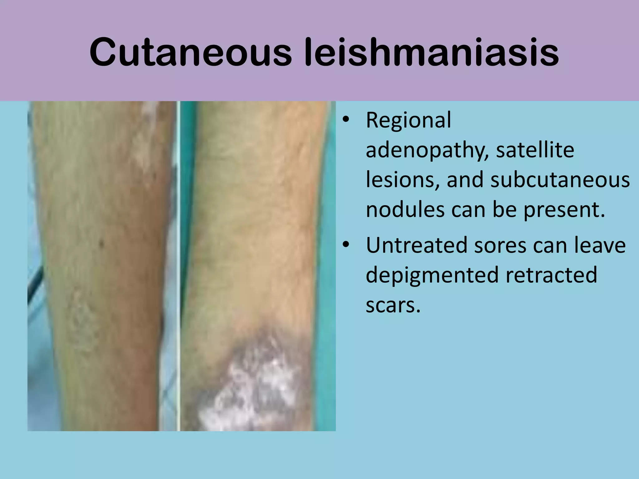 Leishmaniasis | PPTX