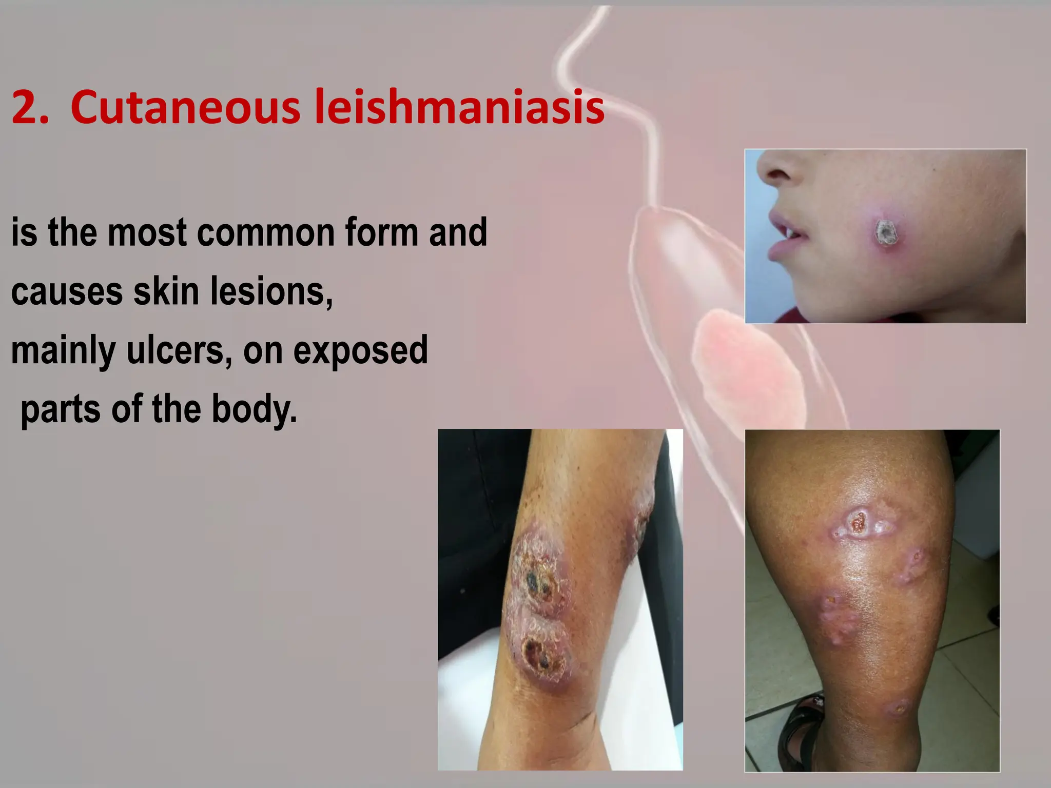 leishmaniasis pro maxxxxxxxxxxxxxxxx.pdf