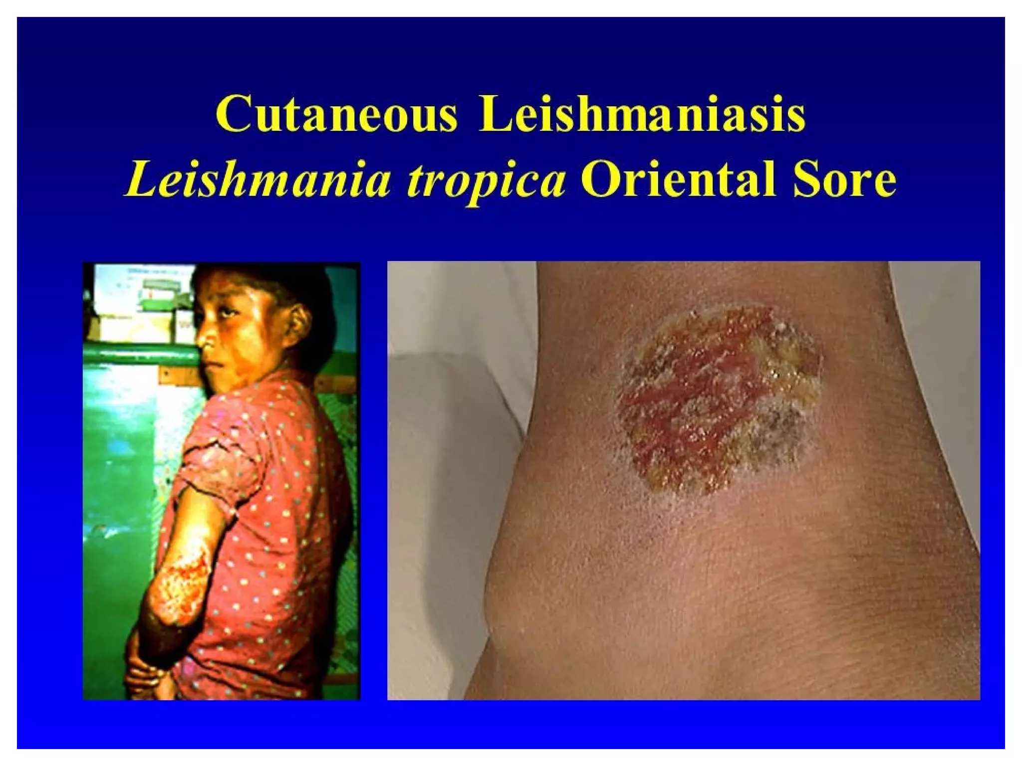 Leishmaniasis | PPT