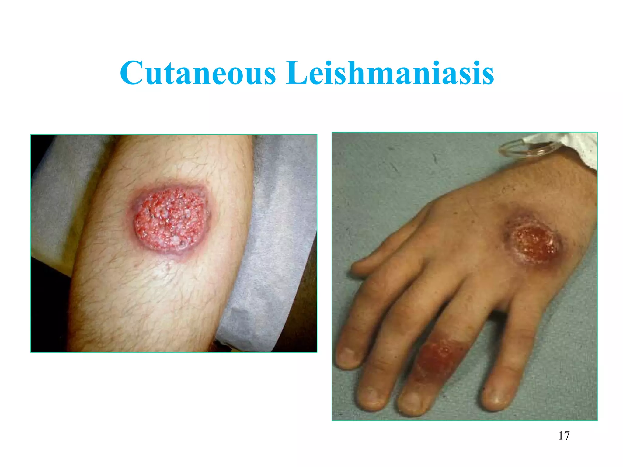 Leishmaniasis | PPT