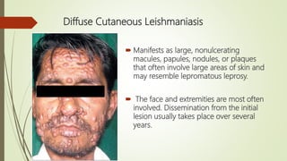 Leishmanisis. | PPTX