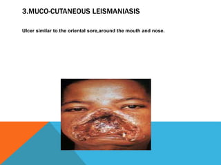 Leishmaniasis | PPTX