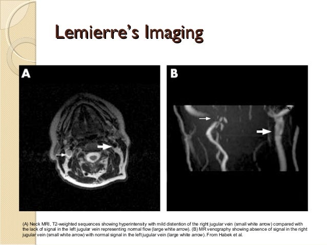 Lemierre's syndrome