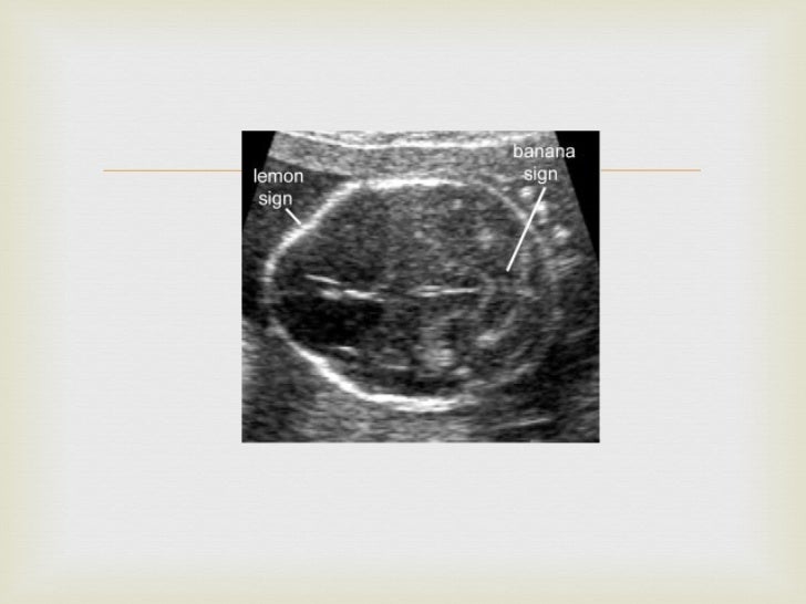 Lemon and Banana signs