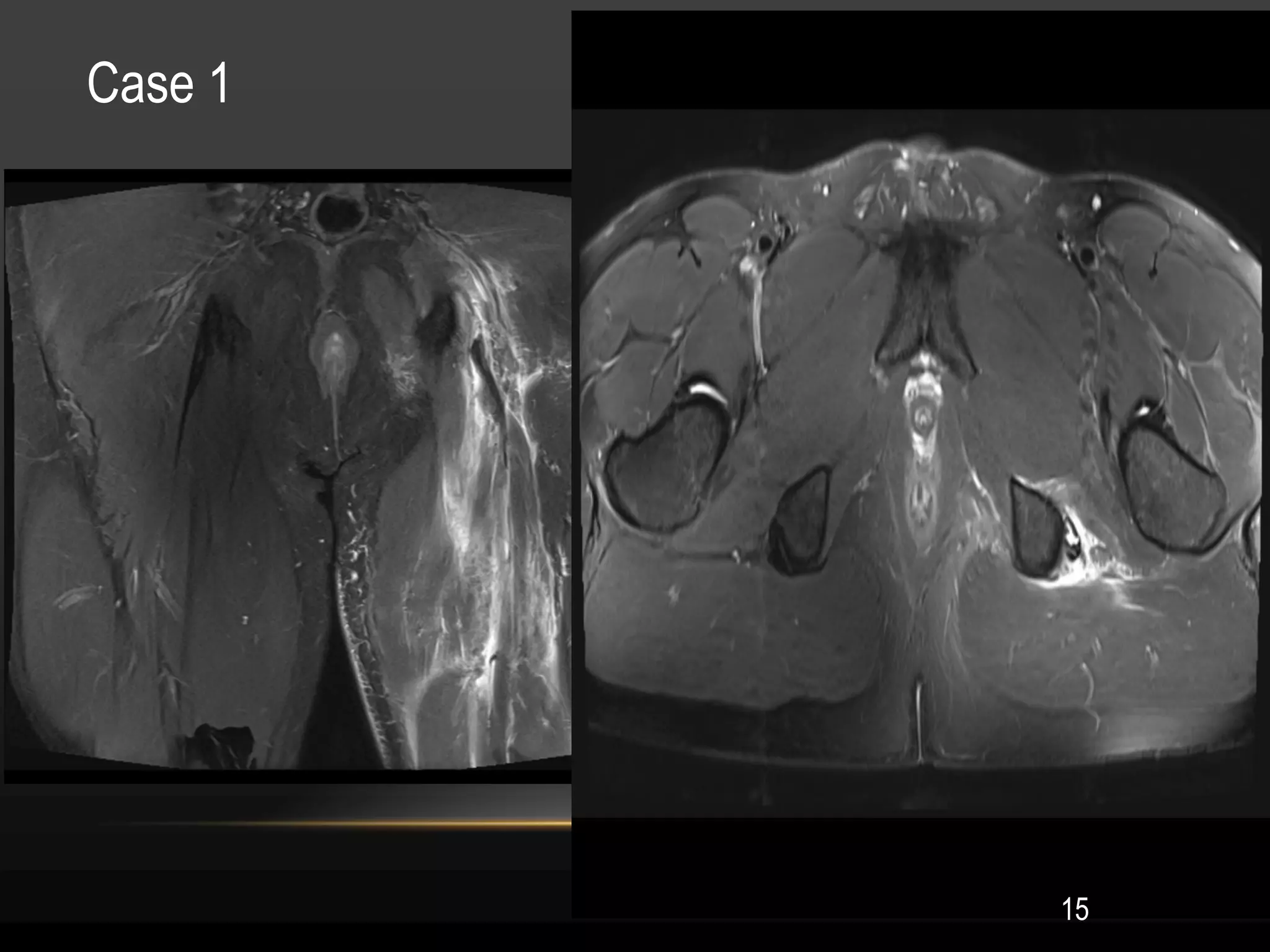 Lasse Lempainen - Hamstring injuries: When is surgery indicated? | PPT