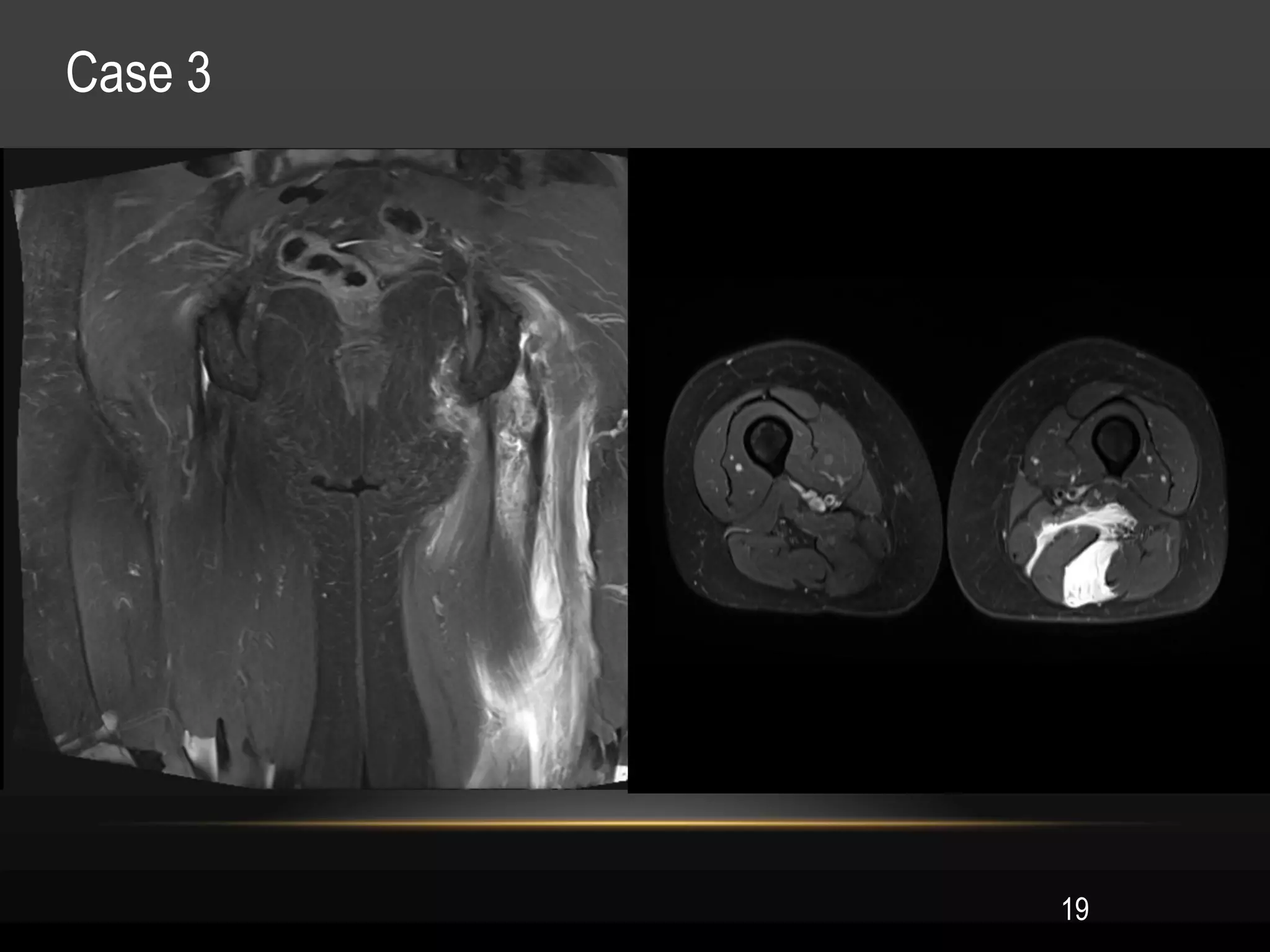 Lasse Lempainen - Hamstring injuries: When is surgery indicated? | PPT