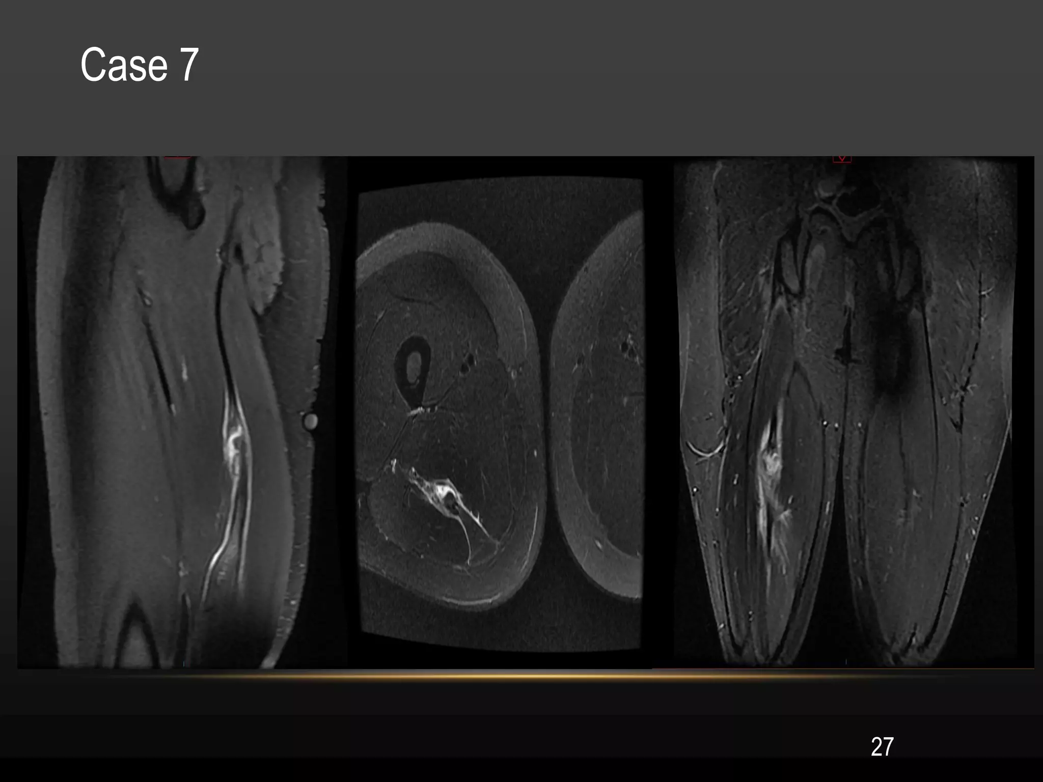 Lasse Lempainen - Hamstring injuries: When is surgery indicated? | PPT