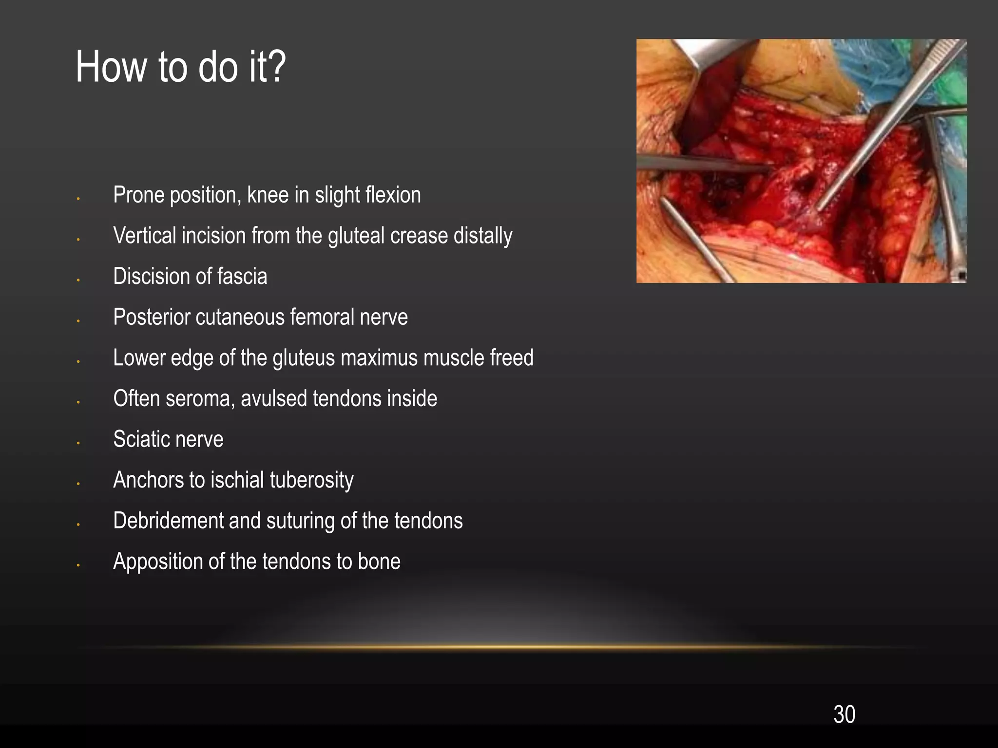Lasse Lempainen - Hamstring injuries: When is surgery indicated? | PPT