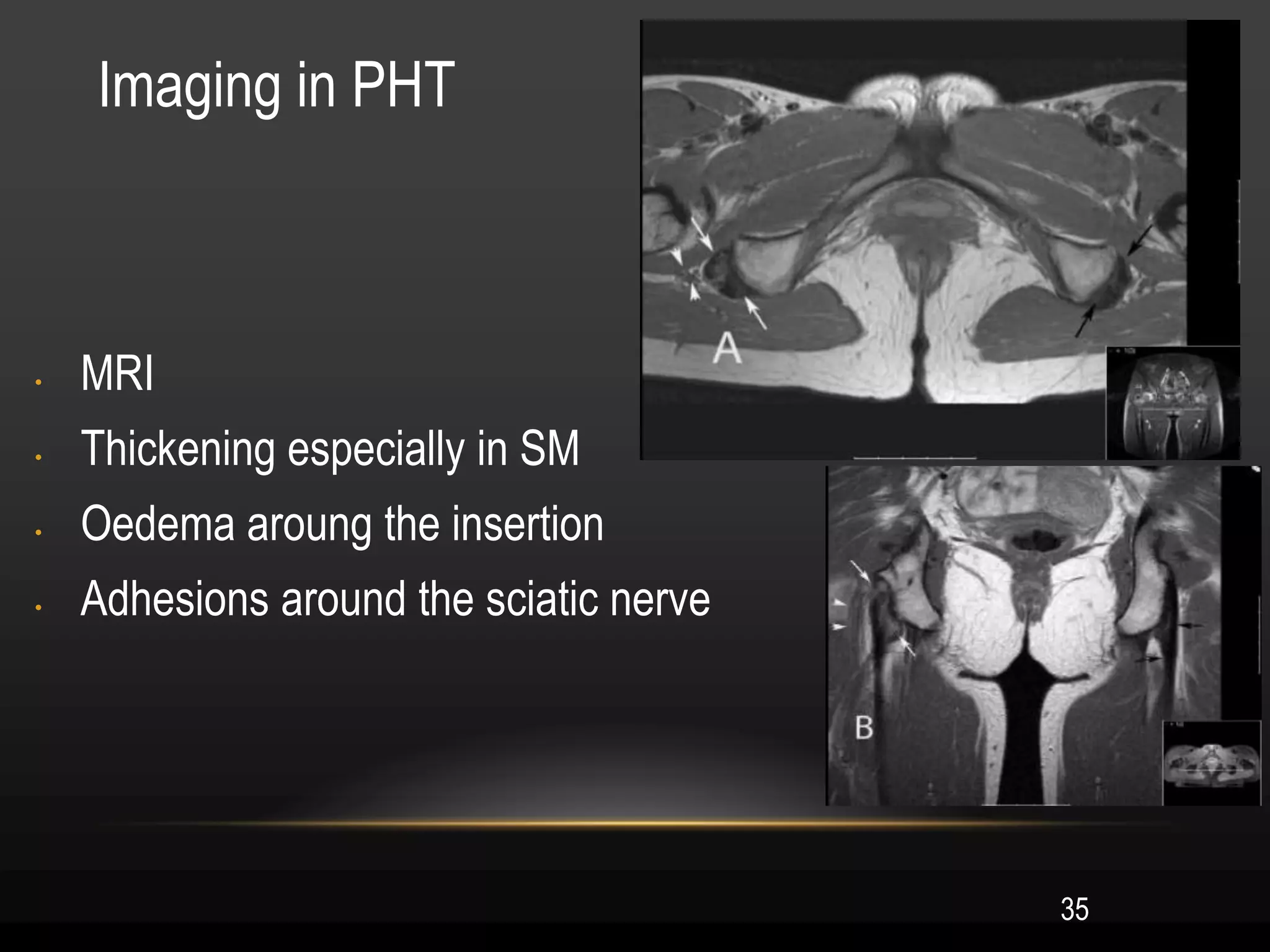 Lasse Lempainen - Hamstring injuries: When is surgery indicated? | PPT