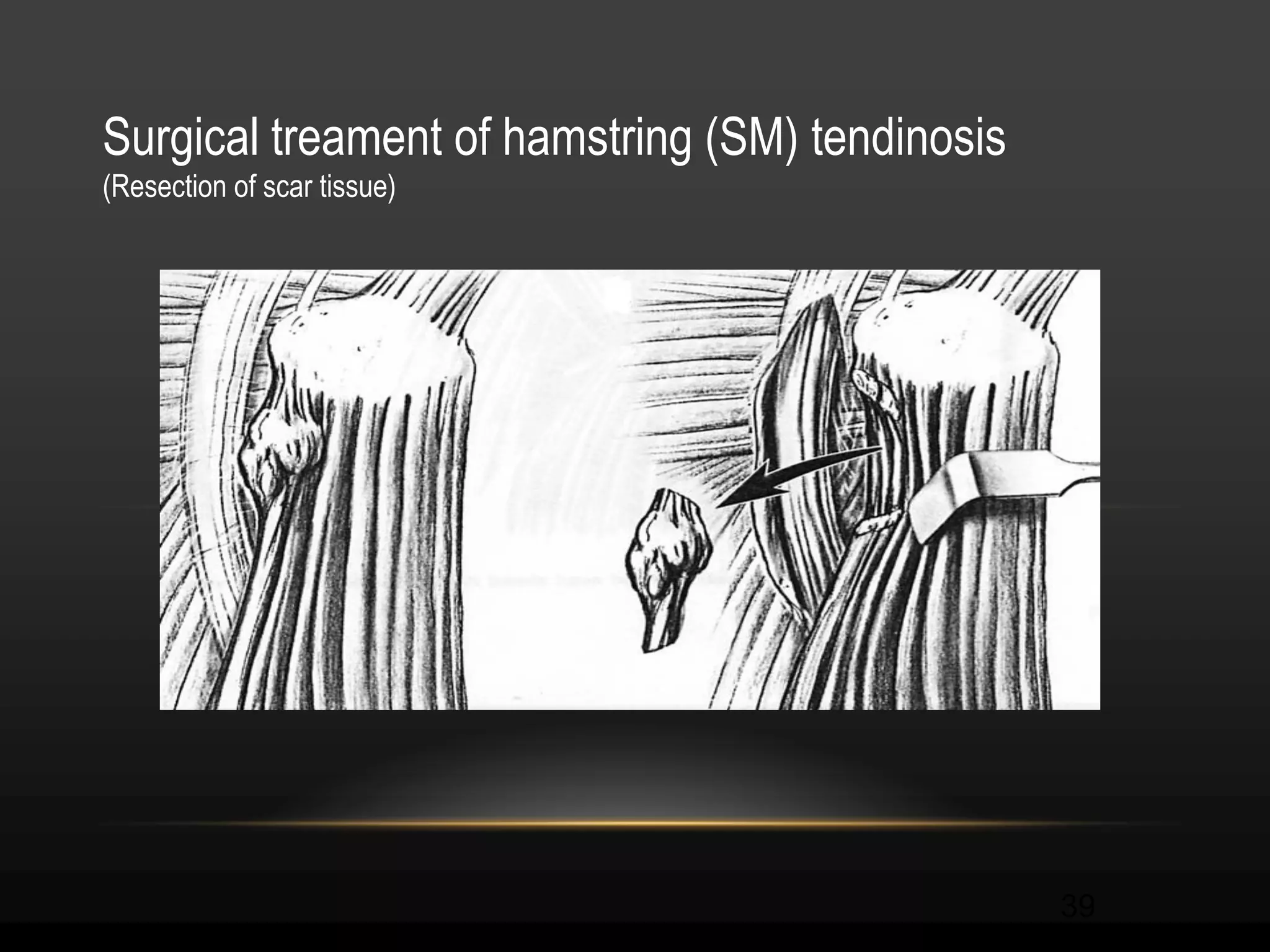 Lasse Lempainen - Hamstring injuries: When is surgery indicated? | PPT