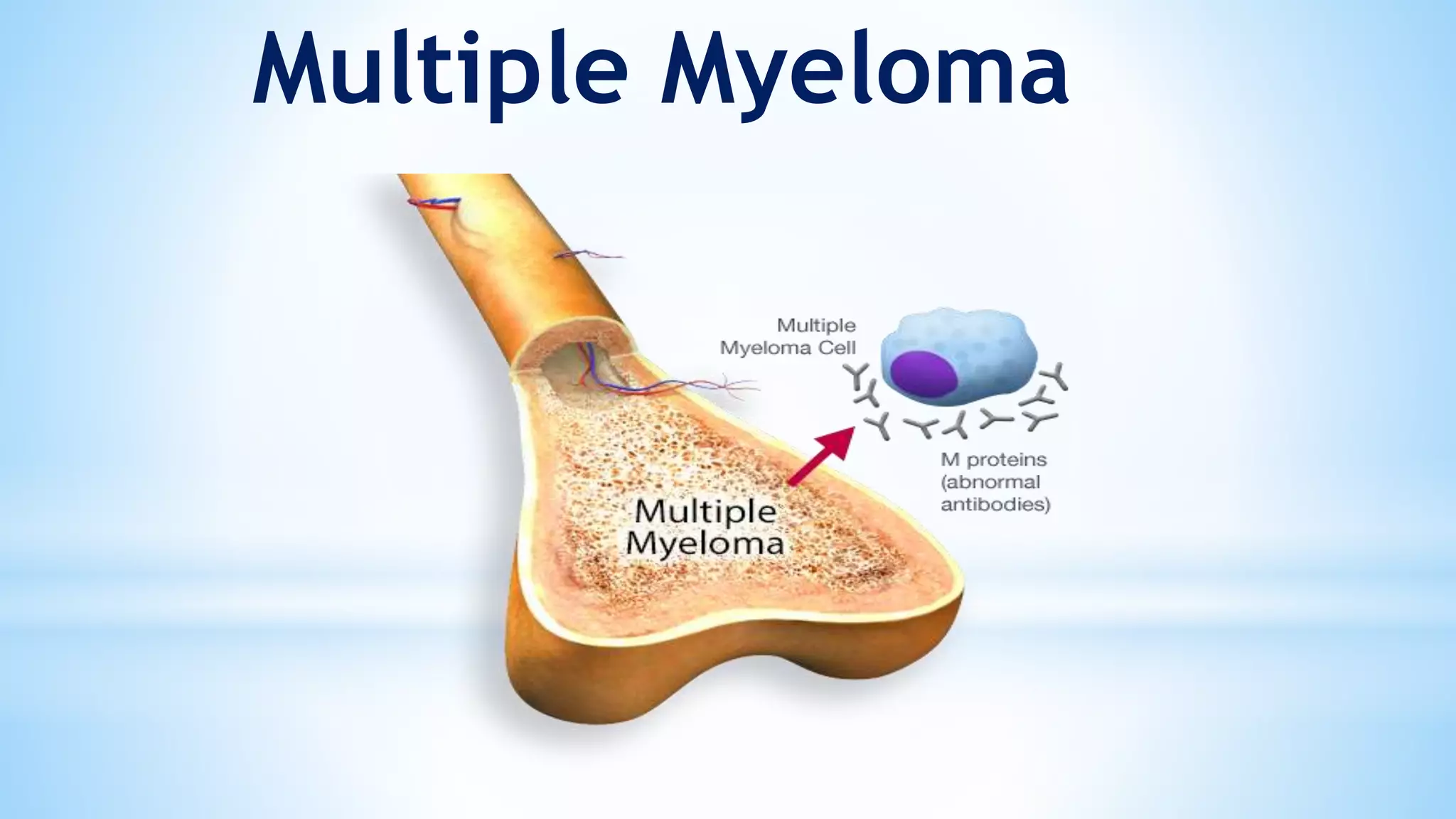 Multiple Myeloma | Causes and Treatment of Multiple Myeloma | PPTX