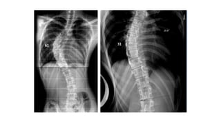 Lenke Classification for Adolescent Idiopathic Scoliosis (AIS) | PPT