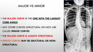 Lenke Classification for Adolescent Idiopathic Scoliosis (AIS) | PPTX