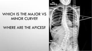 Lenke Classification for Adolescent Idiopathic Scoliosis (AIS) | PPT