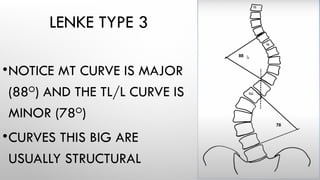 Lenke Classification for Adolescent Idiopathic Scoliosis (AIS) | PPT