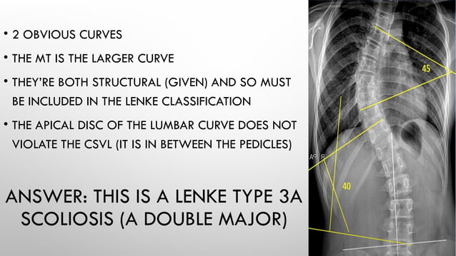 Lenke Classification for Adolescent Idiopathic Scoliosis (AIS) | PPT