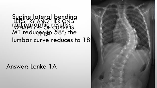 Lenke Classification for Adolescent Idiopathic Scoliosis (AIS) | PPT