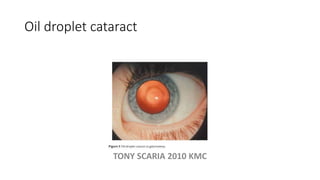 Oil Droplet Cataract