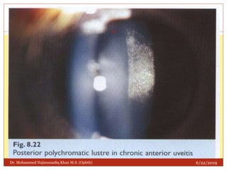 Lens & Cataract | PPTX