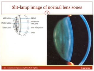 Lens & Cataract | PPTX