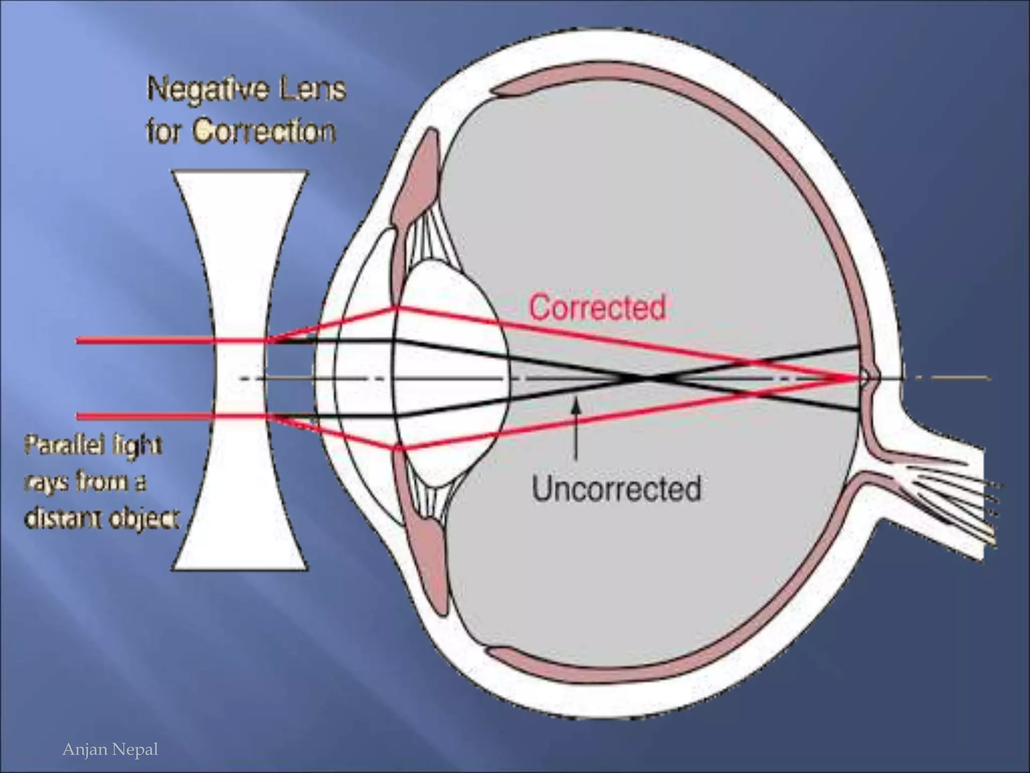 Lenses and defects of vision Light chapter for SEE Nepal | PPT