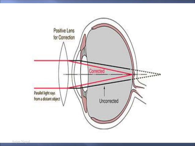Lenses and defects of vision Light chapter for SEE Nepal | PPT