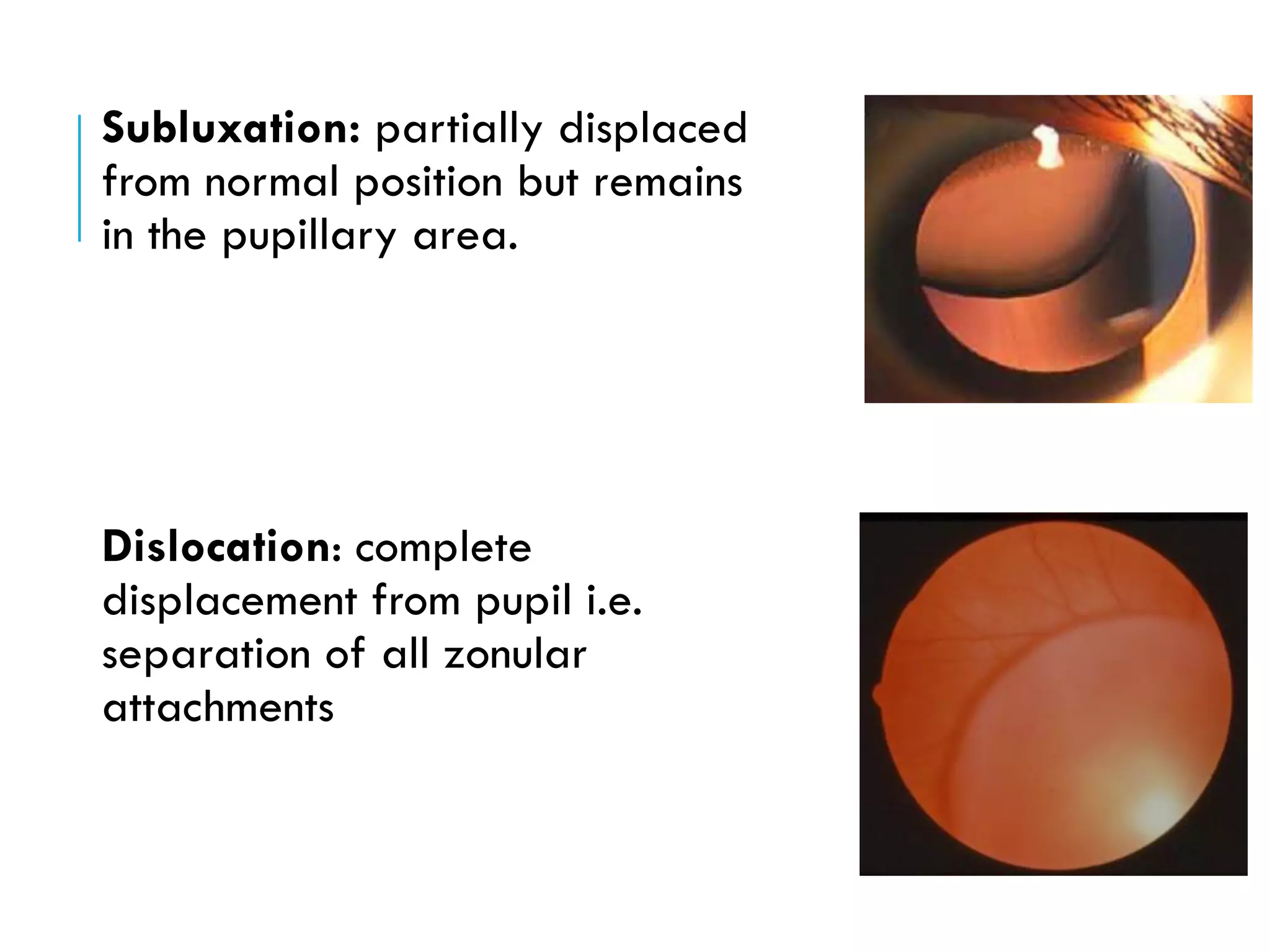 Crystalline Lens | PDF