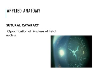 Anterior Axial Embryonic Cataract