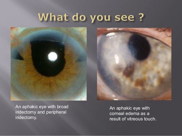 Common Cases: Lens and Glaucoma