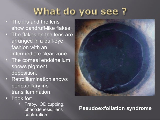 Common Cases: Lens and Glaucoma