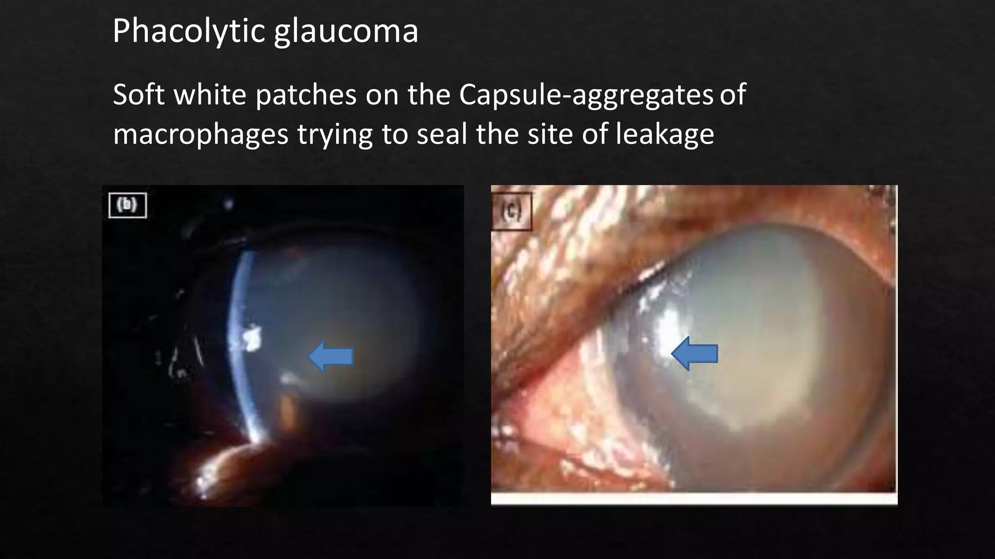 Lens induced glaucoma - DR ARNAV | PPTX