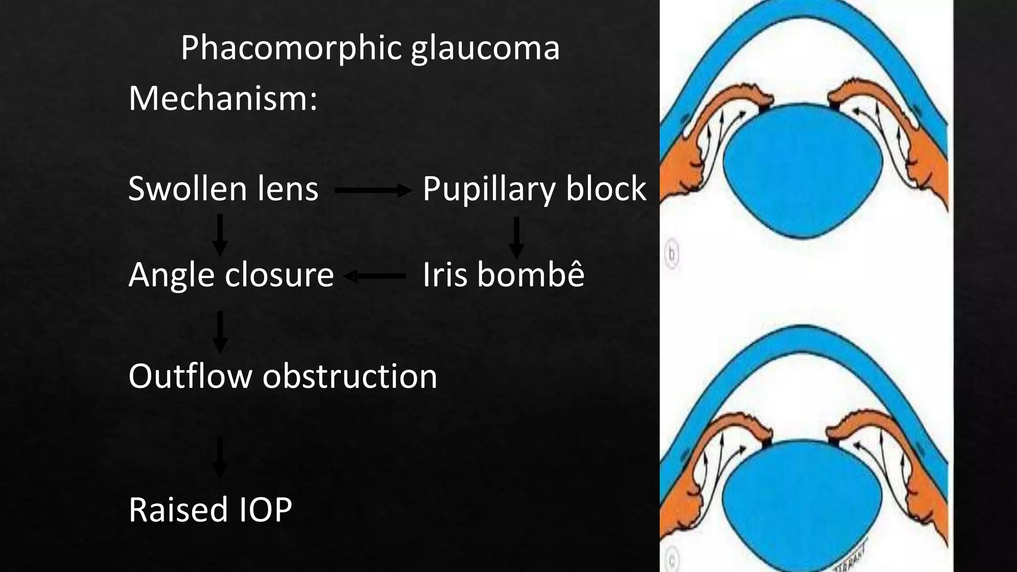 Lens induced glaucoma - DR ARNAV | PPTX