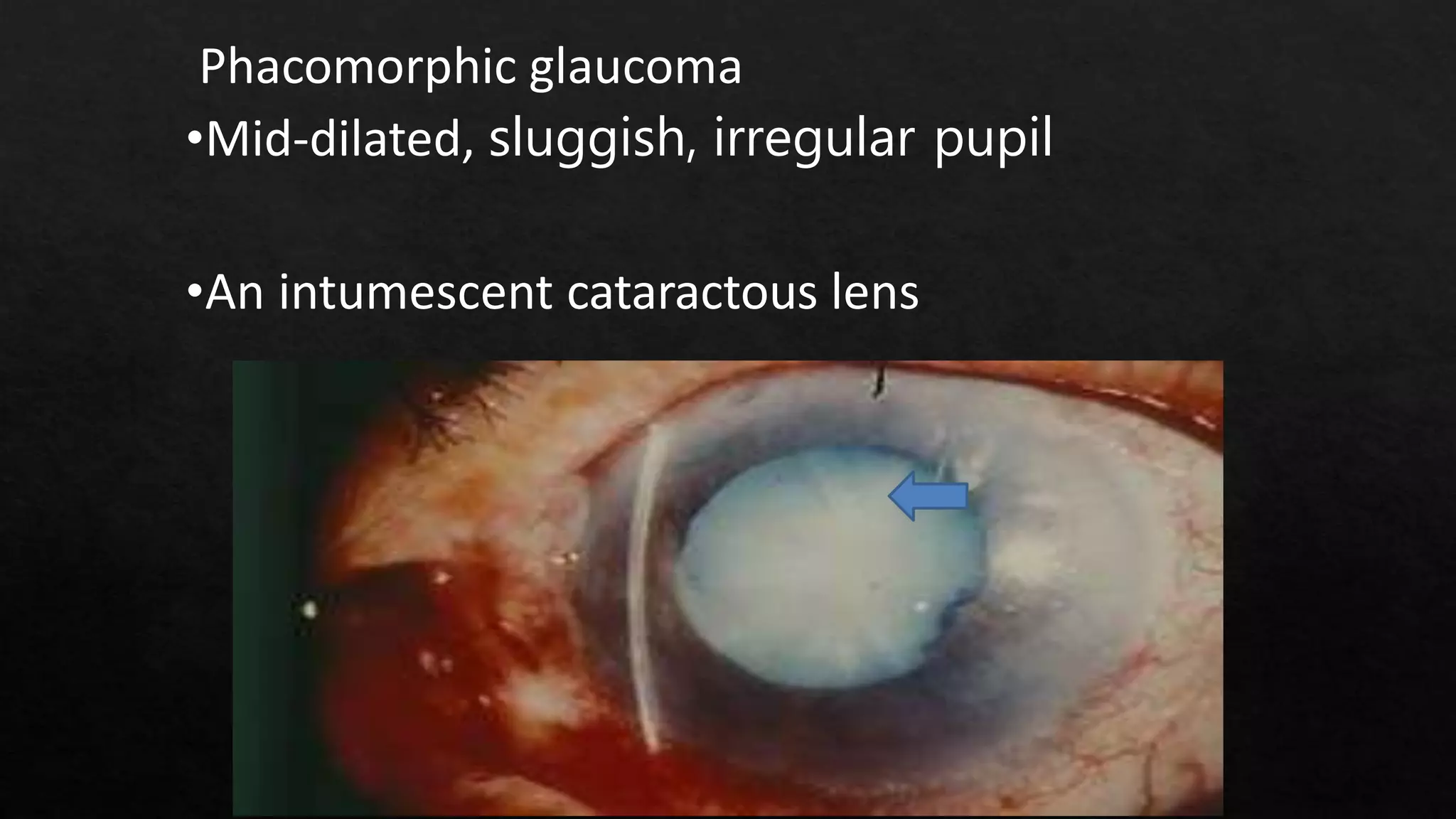 Lens induced glaucoma - DR ARNAV | PPTX